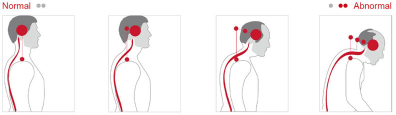 Postural Distortion Patterns Part 2